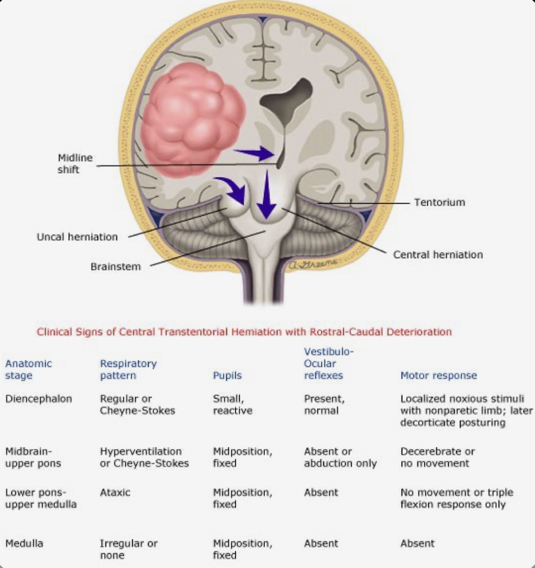 Central Herniation Syndrome