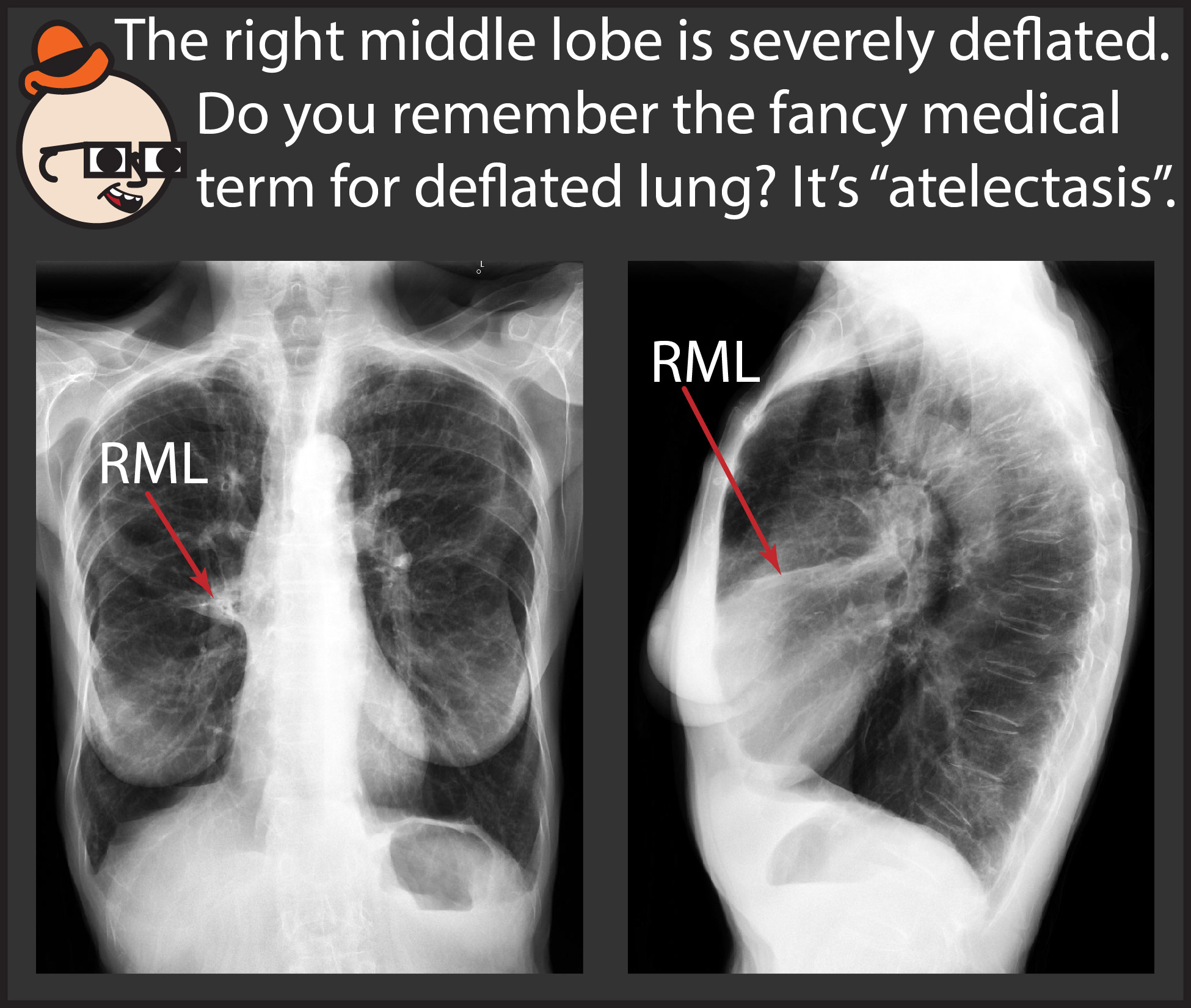 Atelectasis Chest X Ray ICU Chest Films