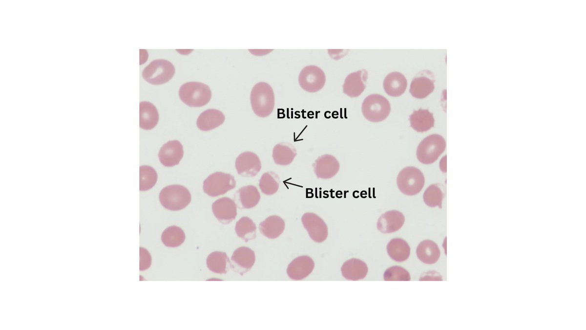 1/11 Acquired Methemoglobinemia 64 yo M presents with B symptoms ...