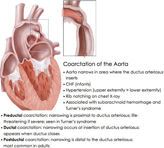 Preductal Coarctation Of Aorta