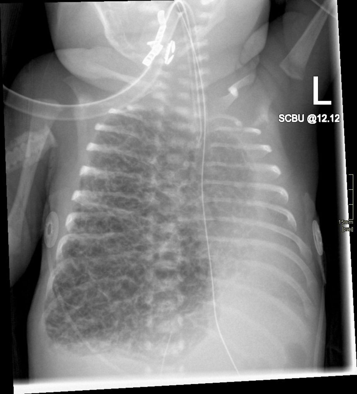 Pulmonary Interstitial Emphysema