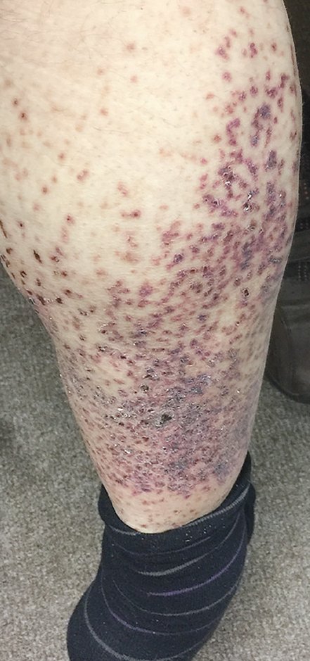 Skin manifestations in hematology A visual 🧵 with diagnosis #MedTwitter ...