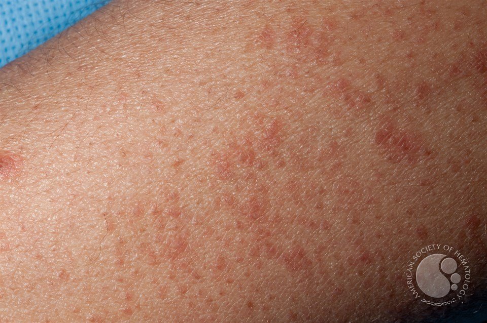 Skin manifestations in hematology A visual 🧵 with diagnosis #MedTwitter ...