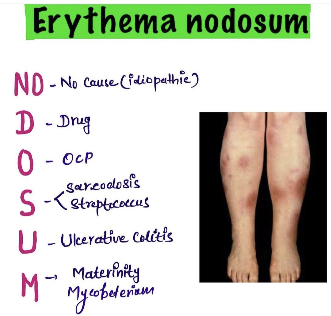 Erythema Nodosum Causes