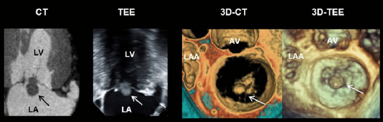 Infective Endocarditis Tee