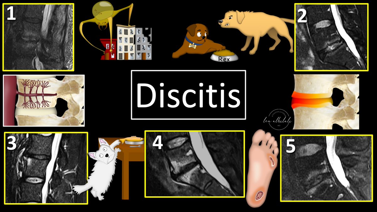 1/Diagnosing discitis can be a pain in the backside! When it’s easy, it’s easy--but when it’s ...