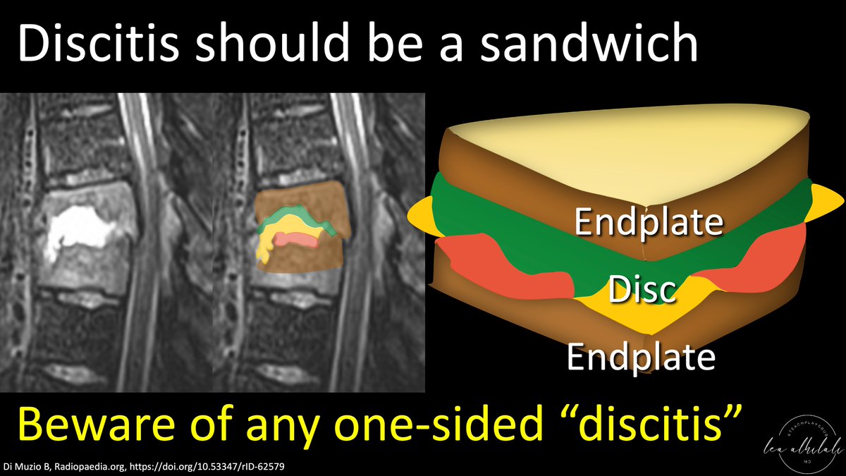 1/Diagnosing discitis can be a pain in the backside! When it’s easy, it ...