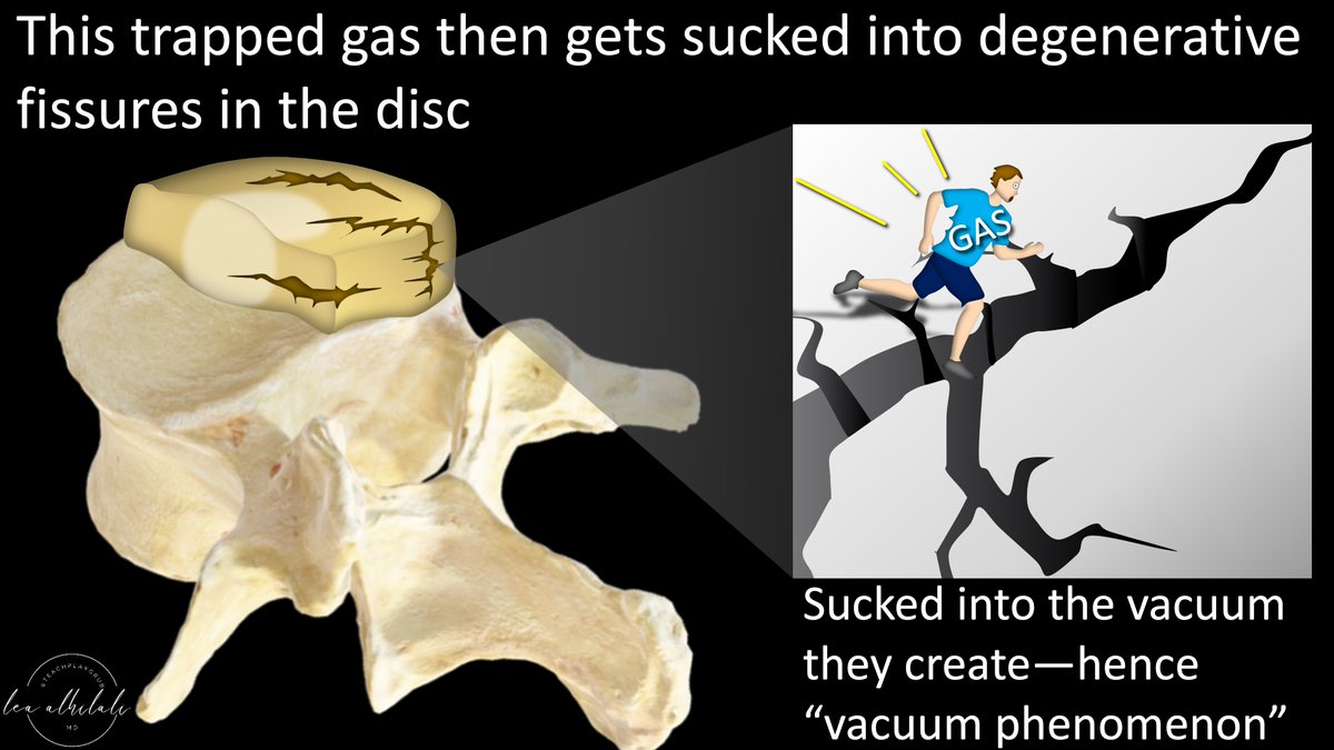 1/Diagnosing discitis can be a pain in the backside! When it’s easy, it ...