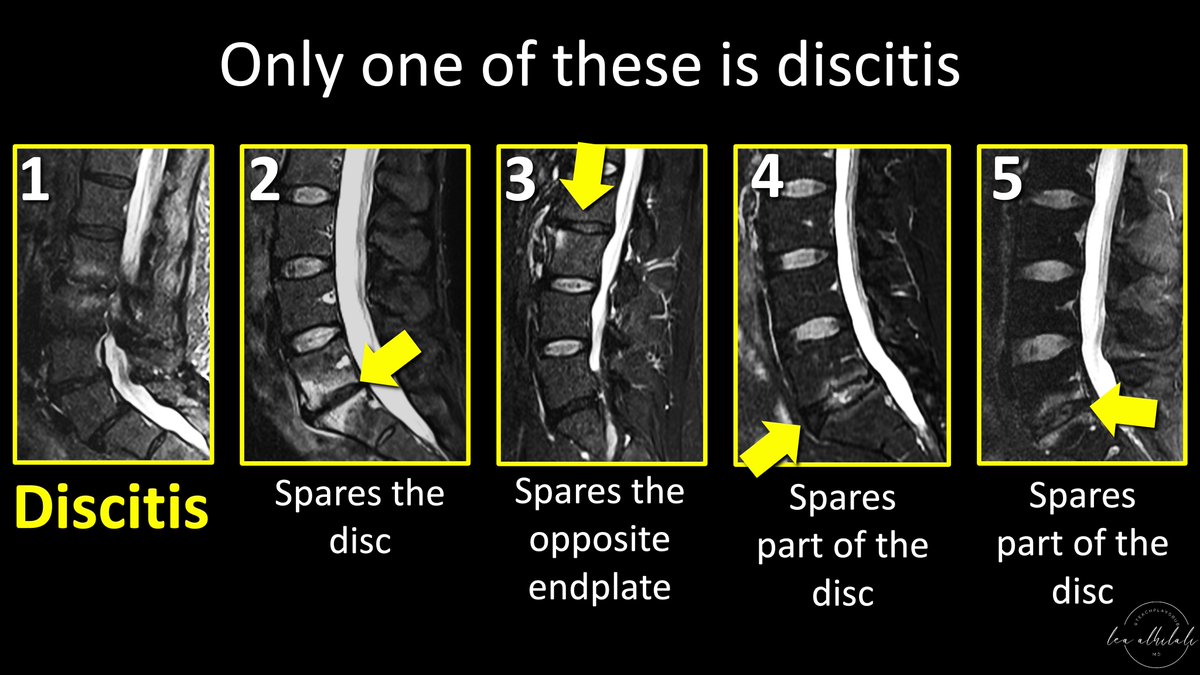 1/Diagnosing discitis can be a pain in the backside! When it’s easy, it’s easy--but when it’s ...