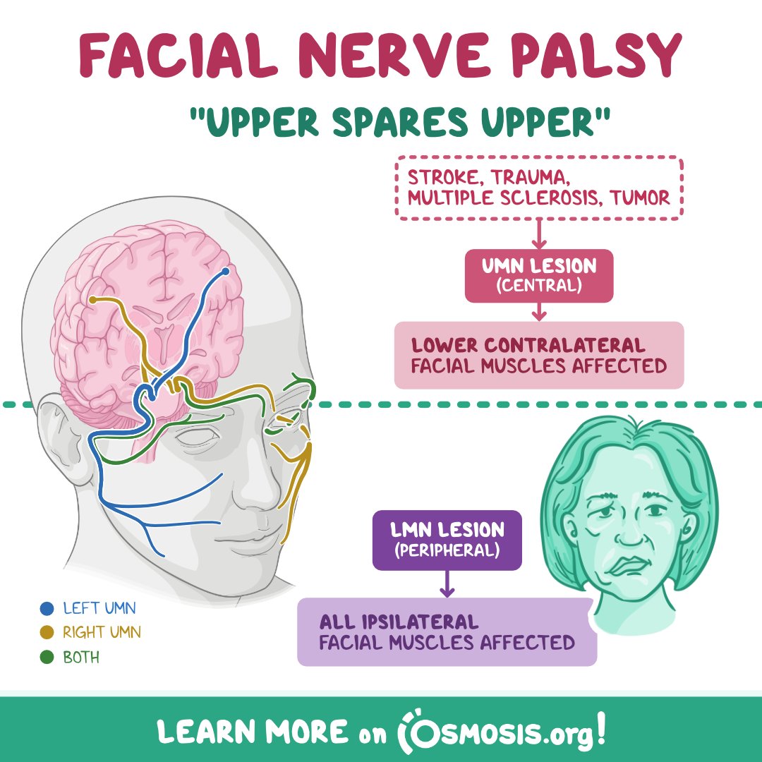 Facial Palsy Muscles Weakness Because Nerve Damage Outline, 56% OFF Facial Palsy Muscles Weakness Because Nerve Damage Outline, 56% OFF