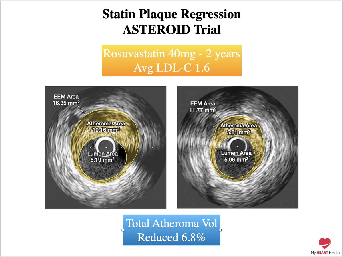Is it possible to reverse coronary artery disease? I get this question ...