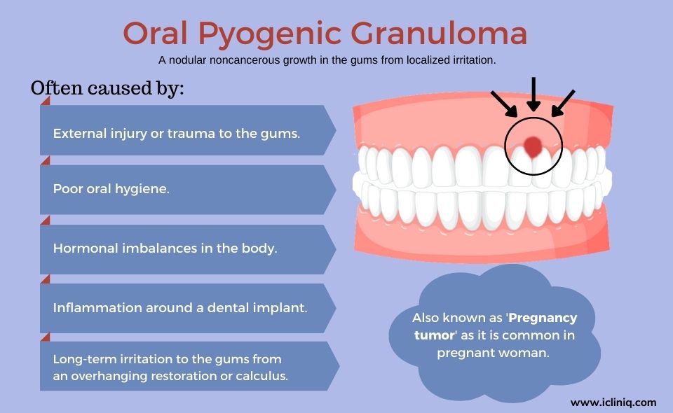 Pyogenic Granuloma In Pregnant Women