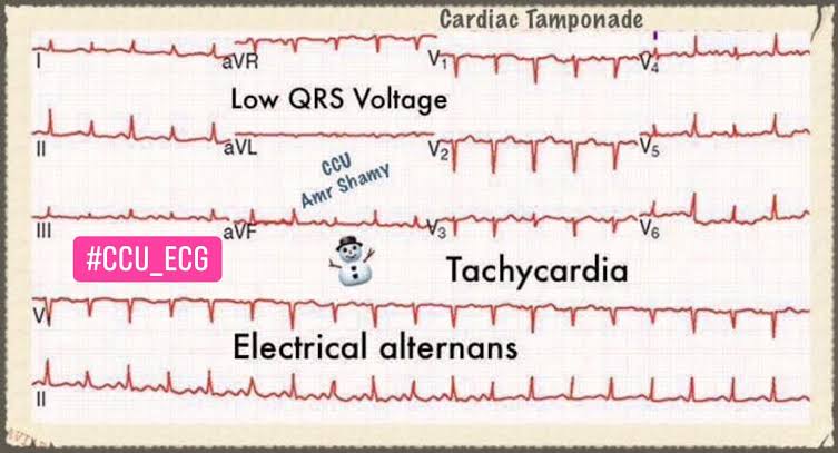 Cardiac Tamponade Ecg Electrocardiographic Changes In Patients With