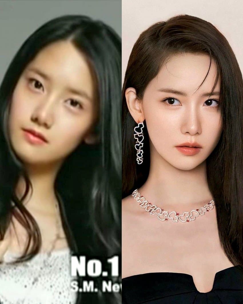 Snsd Yoona Plastic Surgery