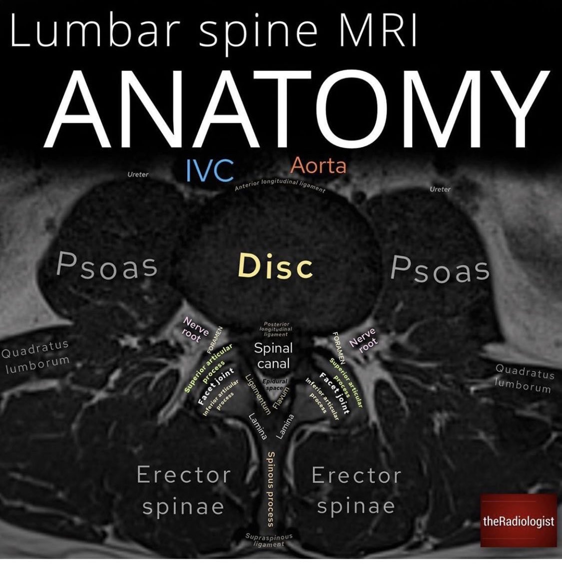 Lumbar Spine Anatomy Mri