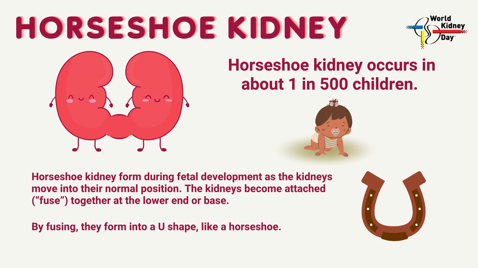 Horseshoe Kidney Symptoms