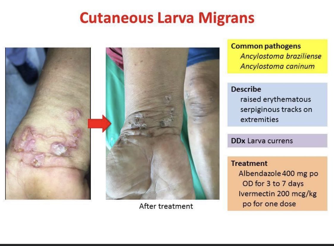 Cutaneous Larva Migrans Hookworm