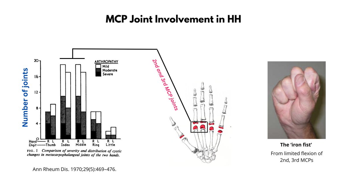1/6 HH and ARTHROPATHY I saw my 1st case of hereditary hemochromatosis ...