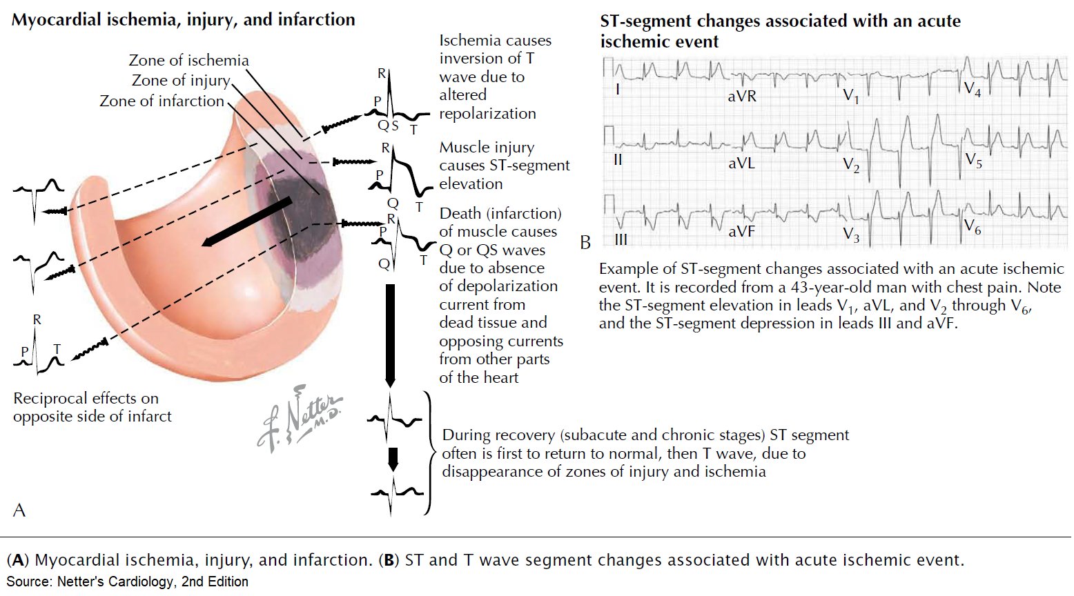 Myocardial Injury Ecg