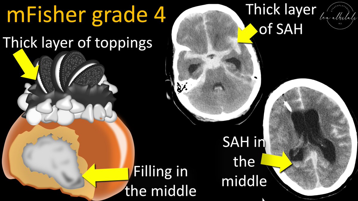 1/Are you FISHING for a way to better evaluate subarachnoid hemorrhage ...