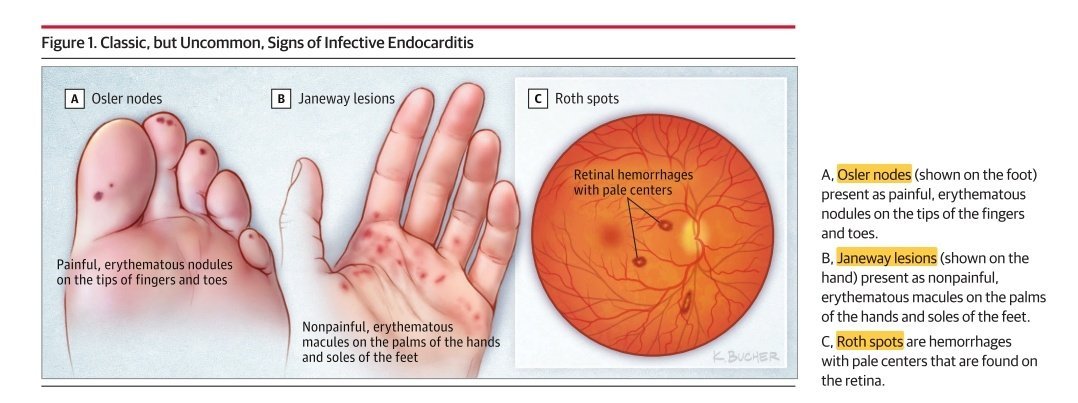 Roth Spots Endocarditis