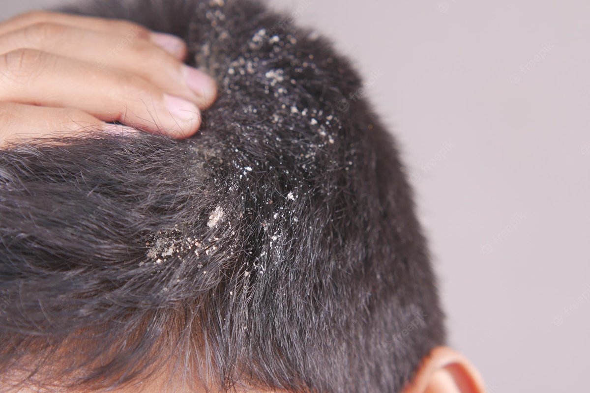 DANDRUFF is annoying. Shampoos and medicated soaps are none of the ...