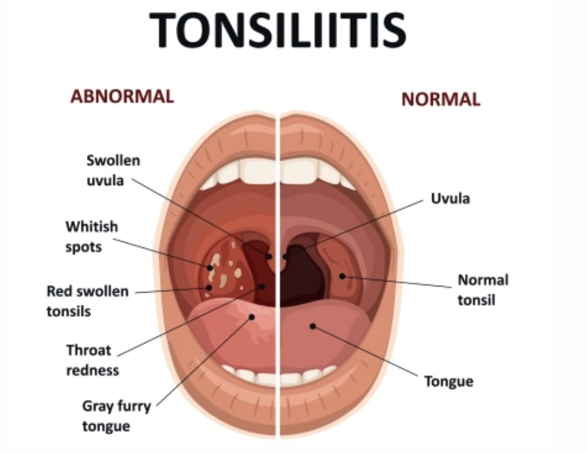 Normal Tonsils Vs Abnormal