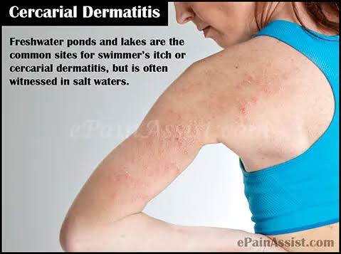 Cercarial Dermatitis