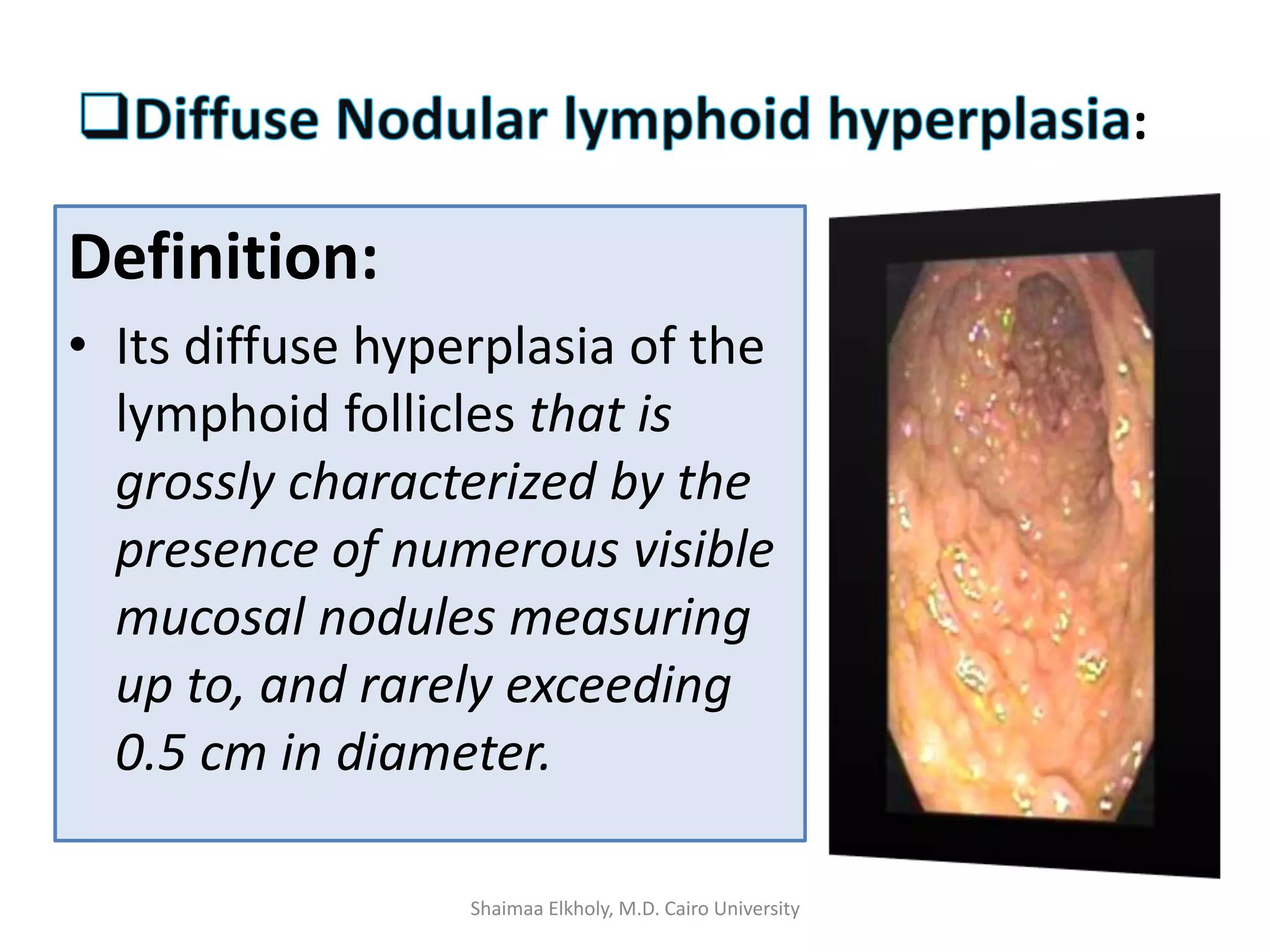 Intestinal Nodular Lymphoid Hyperplasia