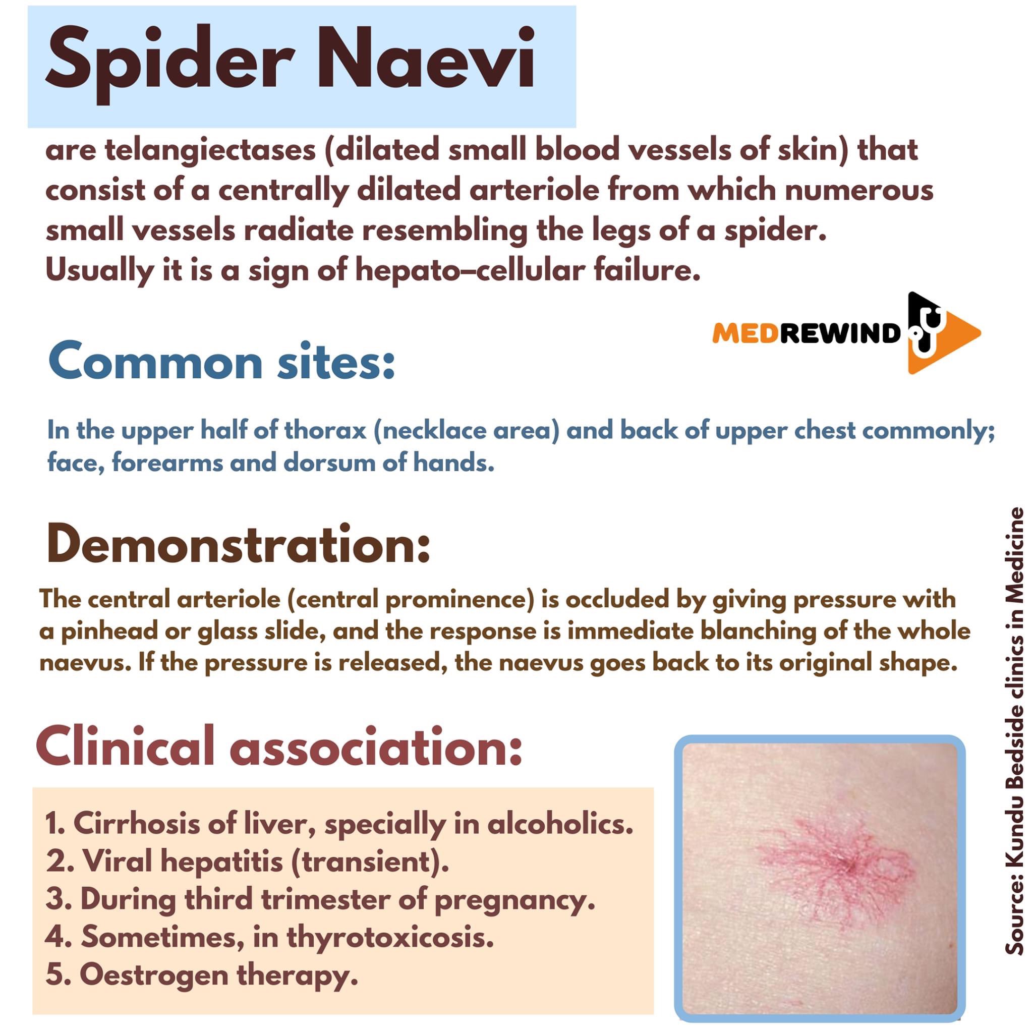 Spider Telangiectasia Liver