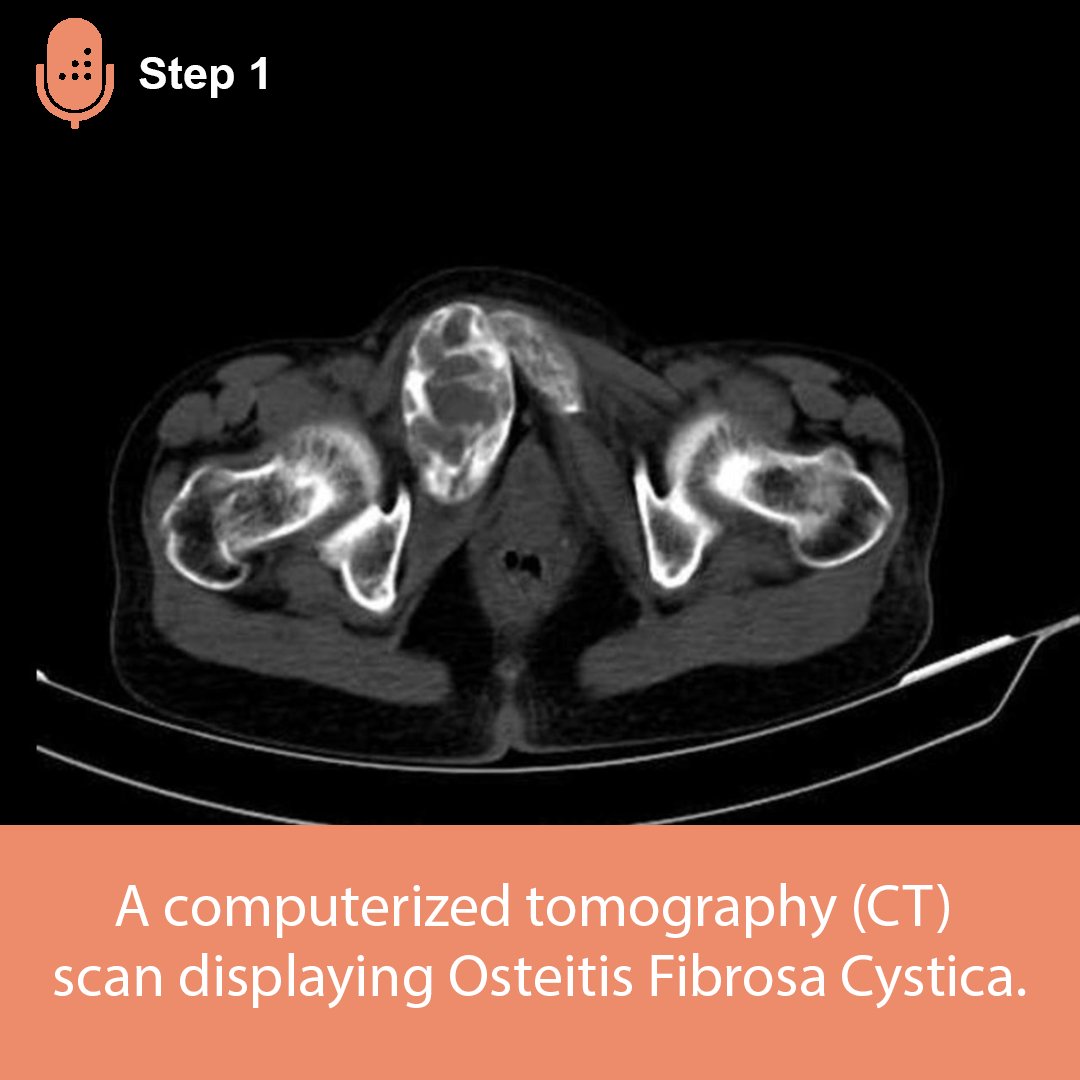 Osteitis Fibrosa Cystica Msk Medbullets Step 1 Osteitis Fibrosa