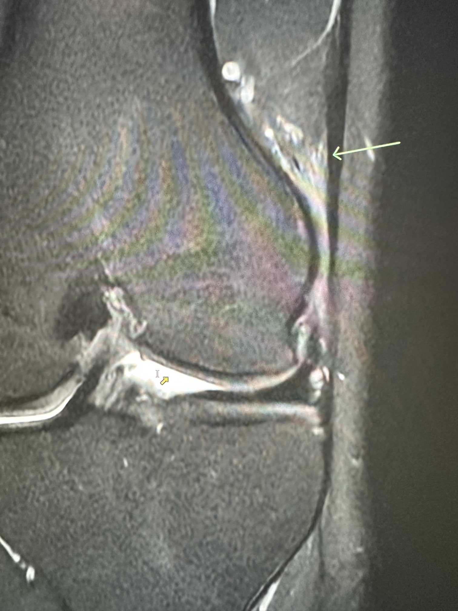 Iliotibial Band Syndrome Mri Iliotibial Band Syndrome MRI Sumer's