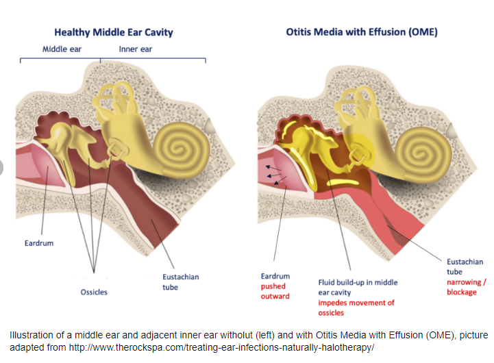 Otitis Media With Effusion