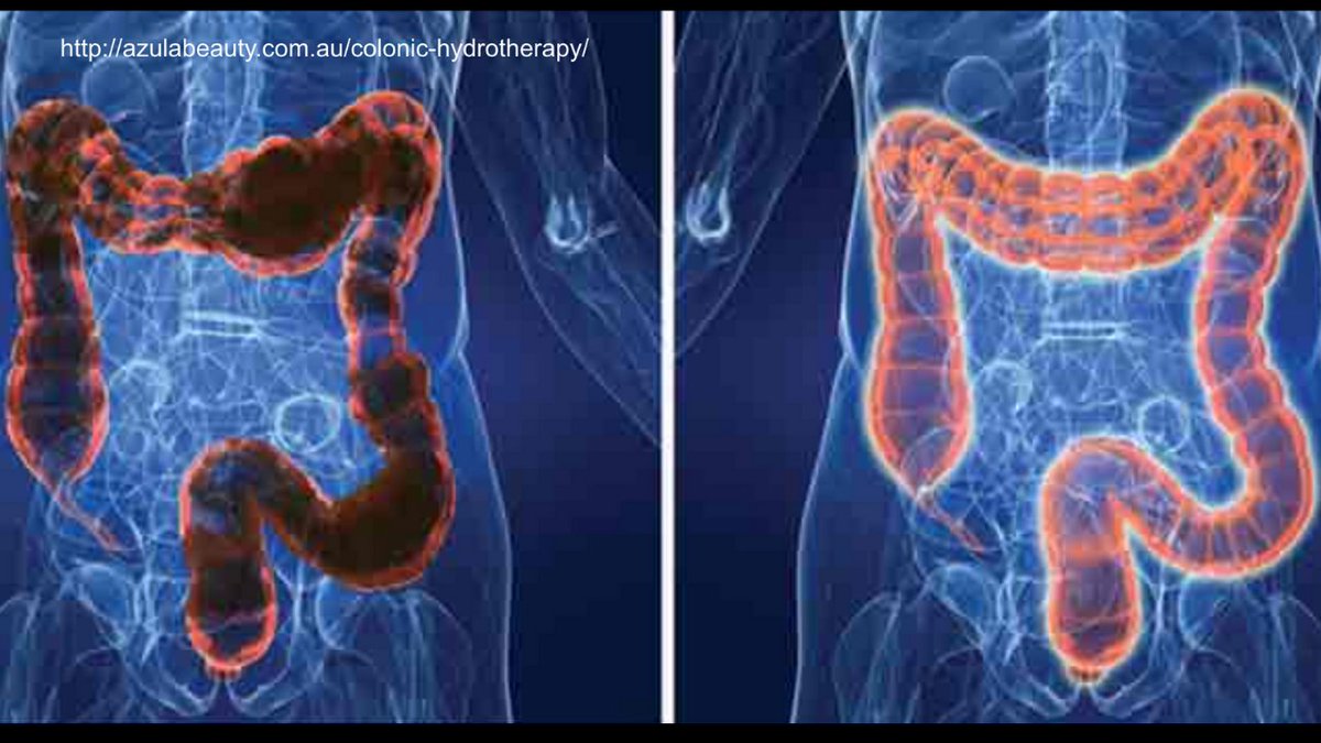 𝐂𝐚𝐧'𝐭 𝐋𝐨𝐬𝐞 𝐖𝐞𝐢𝐠𝐡𝐭? Struggling 𝐰𝐢𝐭𝐡 𝐂𝐨𝐧𝐬𝐭𝐢𝐩𝐚𝐭𝐢𝐨𝐧? 🤫𝐑𝐄𝐕𝐄𝐀𝐋𝐈𝐍𝐆 the 𝗪𝗲𝗶𝗴𝗵𝘁 ...