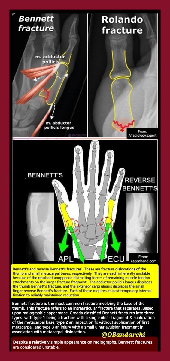 Reverse Bennett Fracture