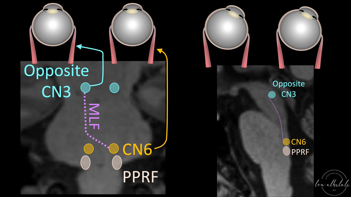 1/Is trying to understand diplopia making you crossed-eyed?! When a ...