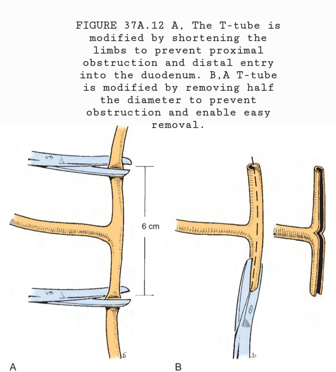 T Tube Drain Removal