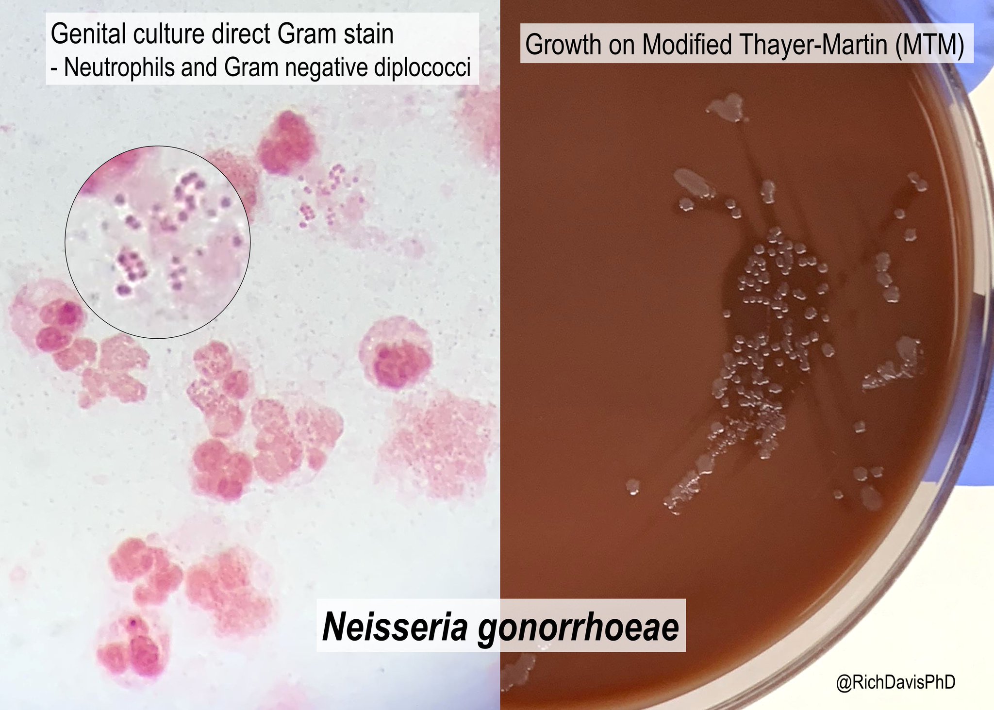 Neisseria Gonorrhoeae Gram Stain Gonorrhea Cells Stock Photos And