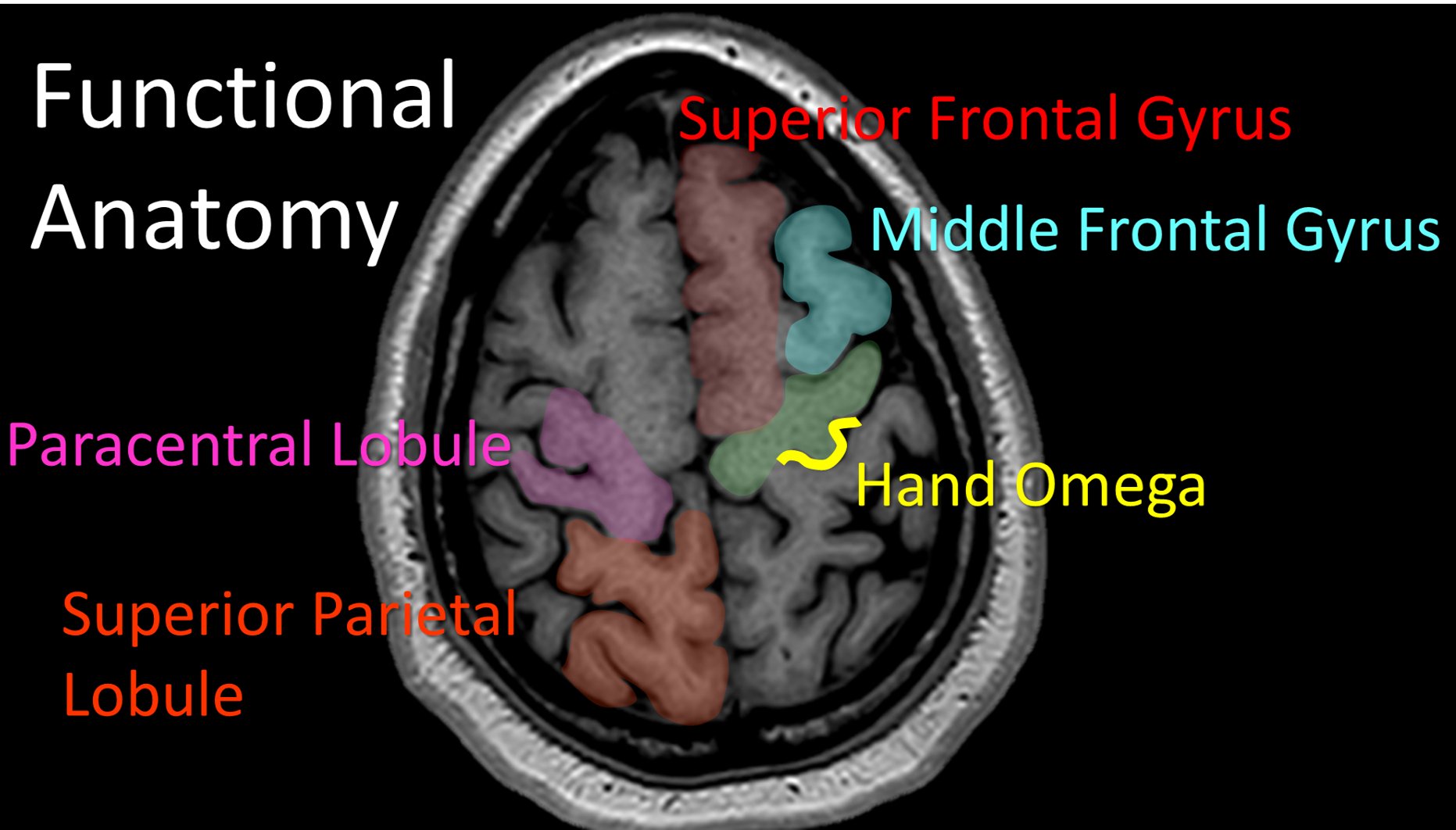 Paracentral Lobule Mri Paracentral Lobule Mri