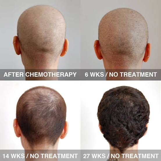 The classic look for cancer patients is a person with a bald head. Here ...