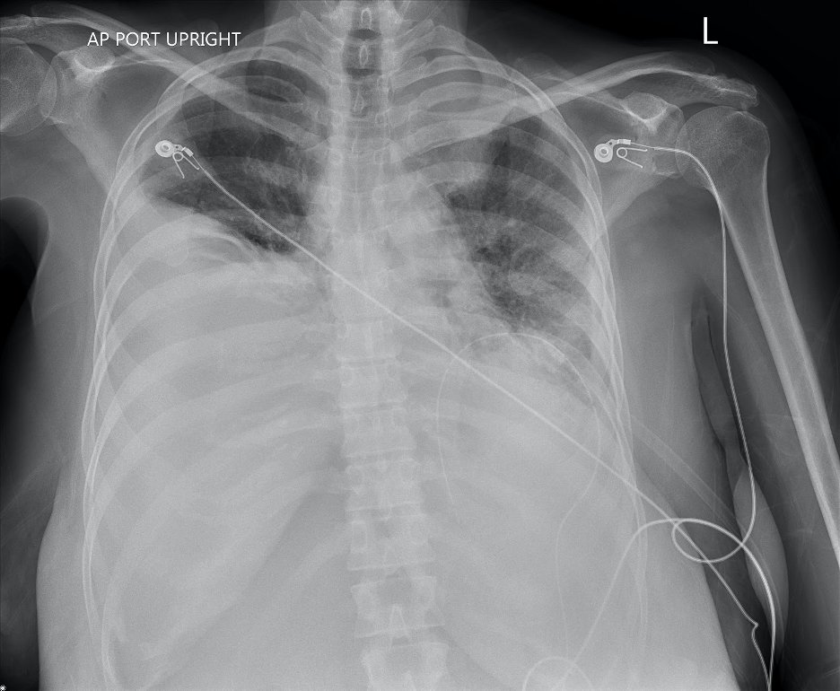 51-yr-old female with a hx of metastatic ovarian cancer on chemotherapy ...