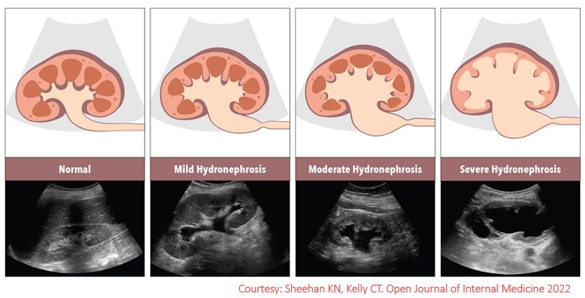 Moderate Hydronephrosis Ultrasound