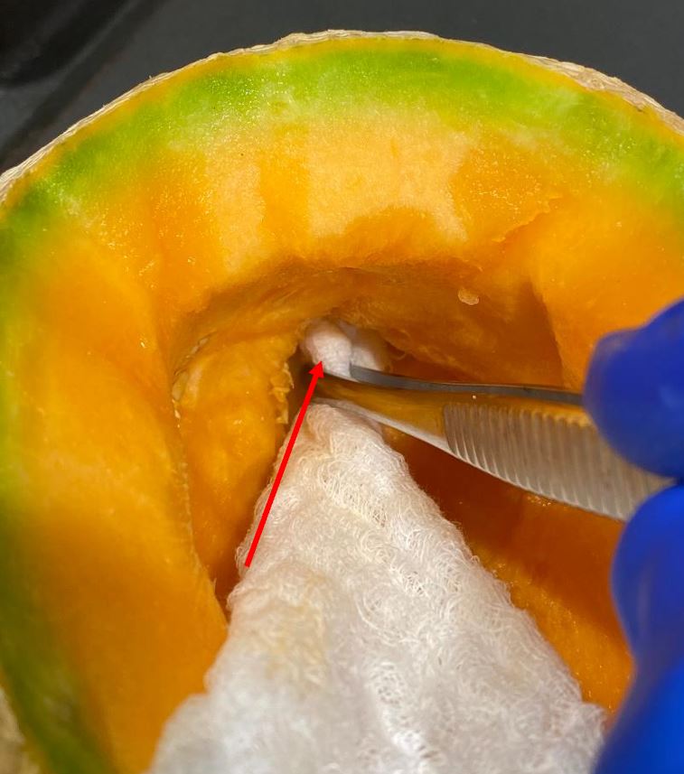 🧵regarding the packing of cavities for hemostasis during surgery: Here ...