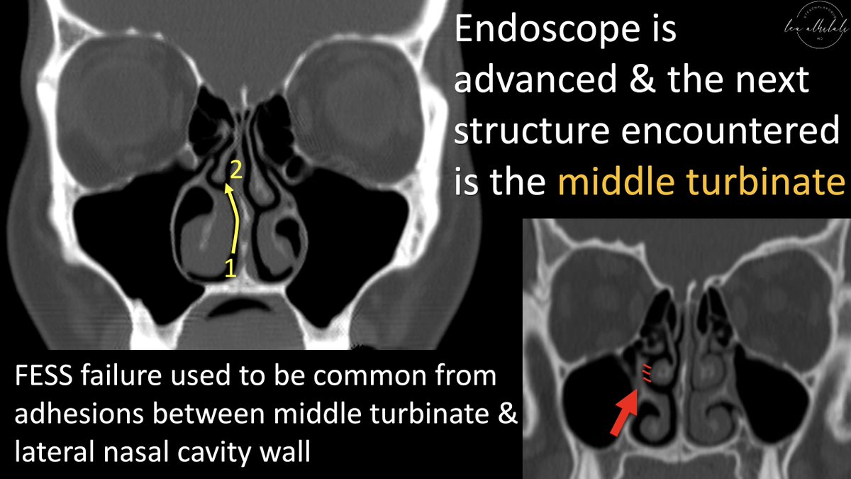 1/Time to FESS up! Do you understand functional endoscopic sinus surgery (FESS)? If you read ...