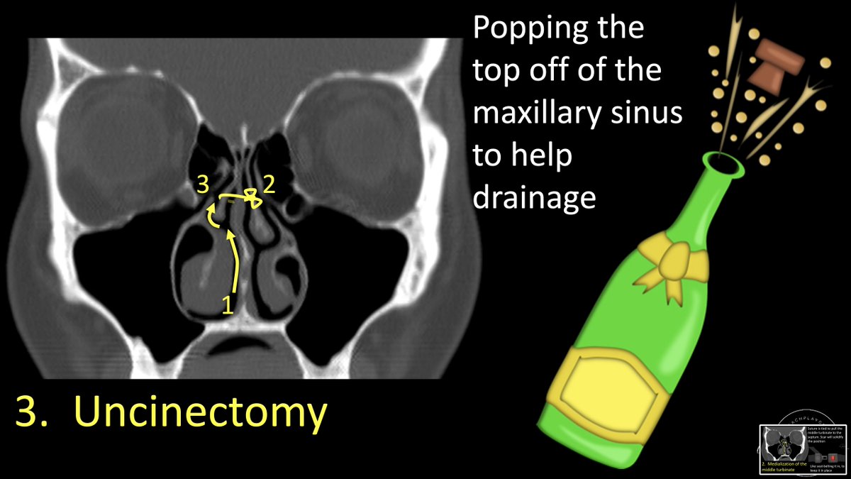 1/Time to FESS up! Do you understand functional endoscopic sinus ...