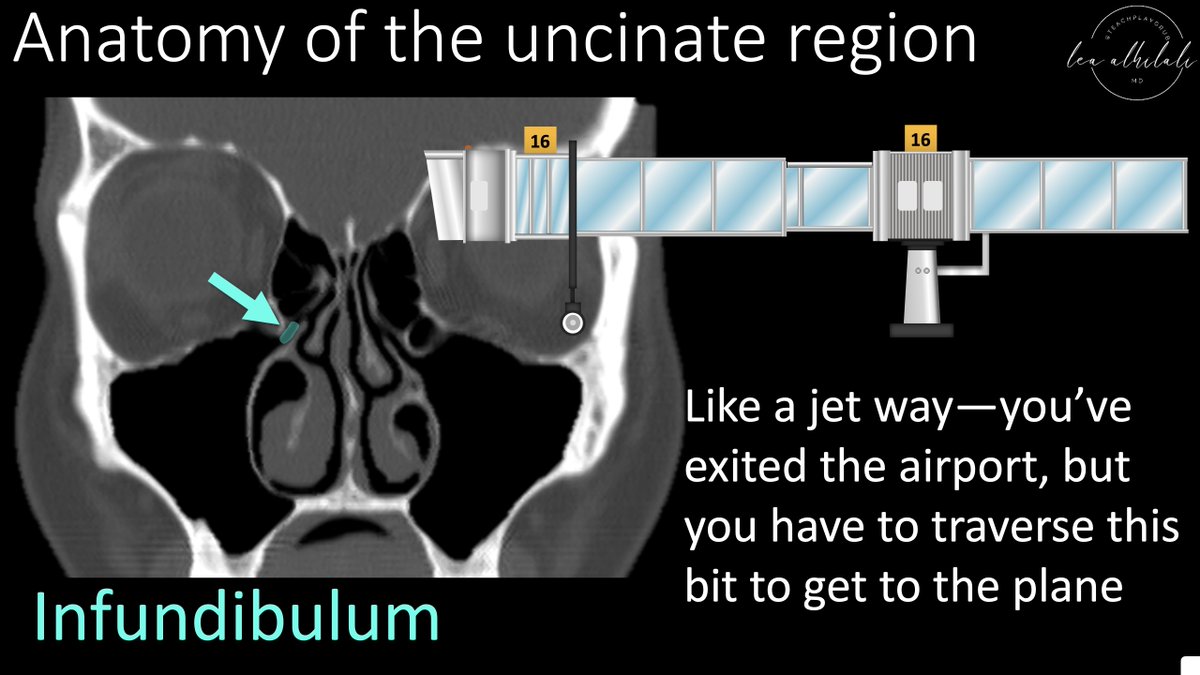1/Time to FESS up! Do you understand functional endoscopic sinus ...