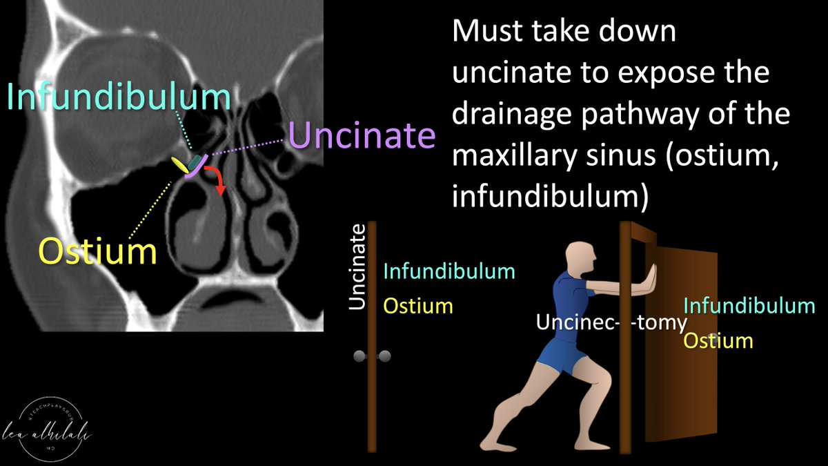 1/Time to FESS up! Do you understand functional endoscopic sinus ...