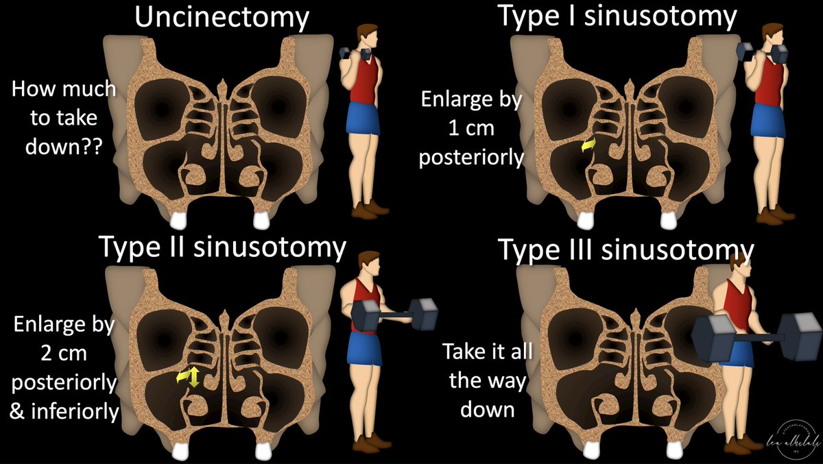 1/Time to FESS up! Do you understand functional endoscopic sinus ...