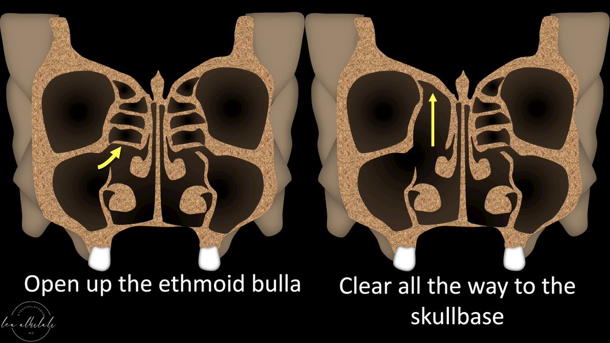 1/Time to FESS up! Do you understand functional endoscopic sinus ...
