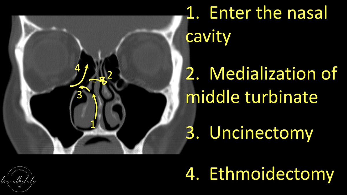 1/Time to FESS up! Do you understand functional endoscopic sinus ...